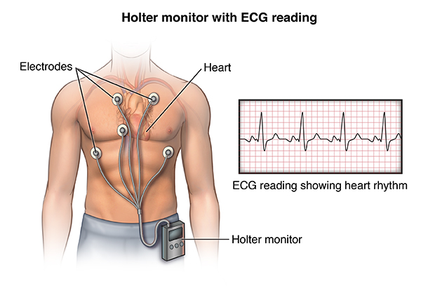 Holter Monitor Test – Dr. Padgaonkar's Heart Clinic